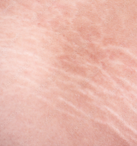 Stretch Marks on Back: Cause, Treatment in Teens - Home Remedy